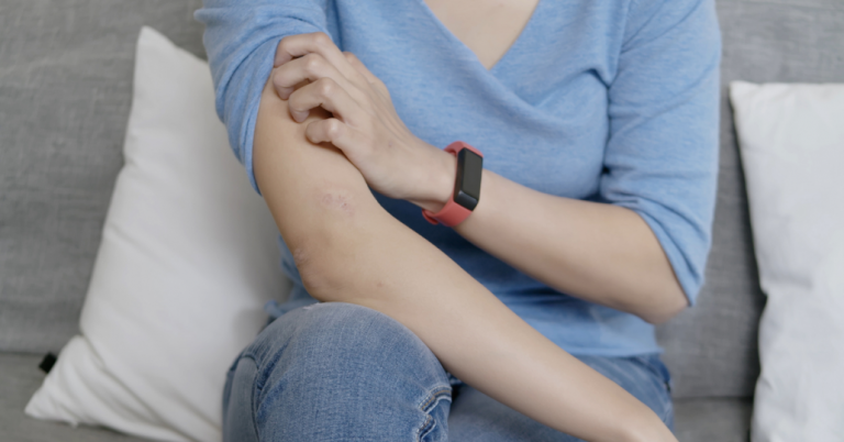 How To Care For Skin During Radiation | SERO