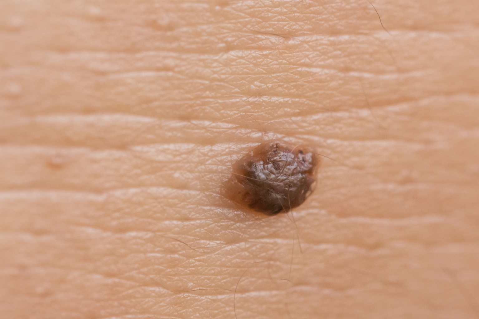 Atypical Moles Vs Precancerous Moles Vs Normal Moles | SERO