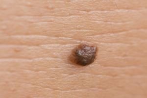 Atypical Moles Vs Precancerous Moles Vs Normal Moles | SERO