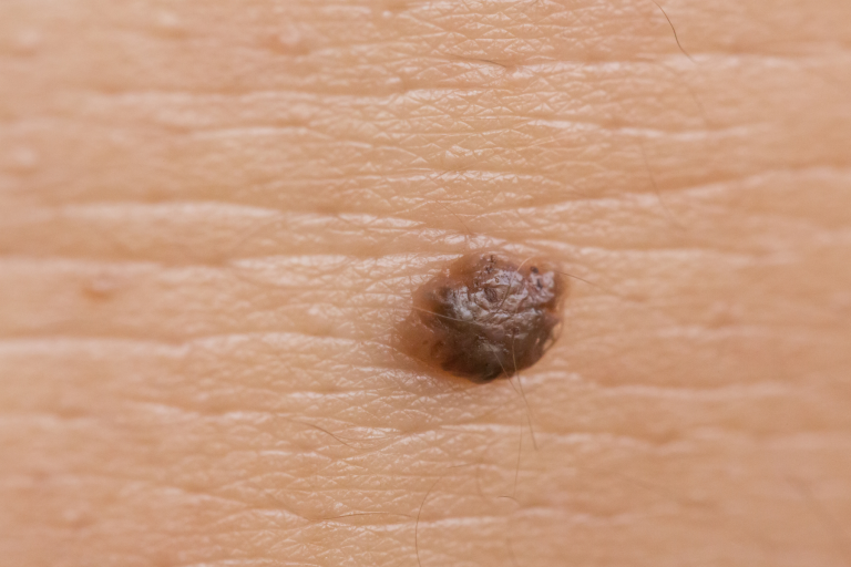 Atypical Moles Vs Precancerous Moles Vs Normal Moles | SERO